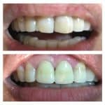 Tooth-colored restoration in Malolos Bulacan | Dr. Keith's Dental Clinic