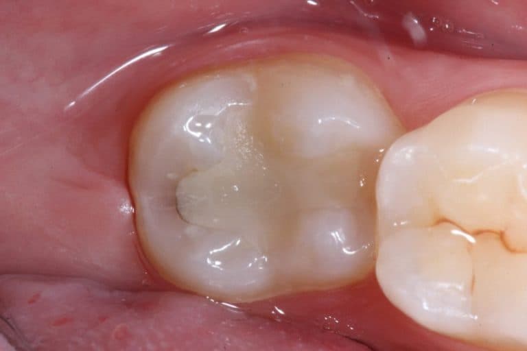 Tooth-colored restoration in Malolos Bulacan | Dr. Keith's Dental Clinic