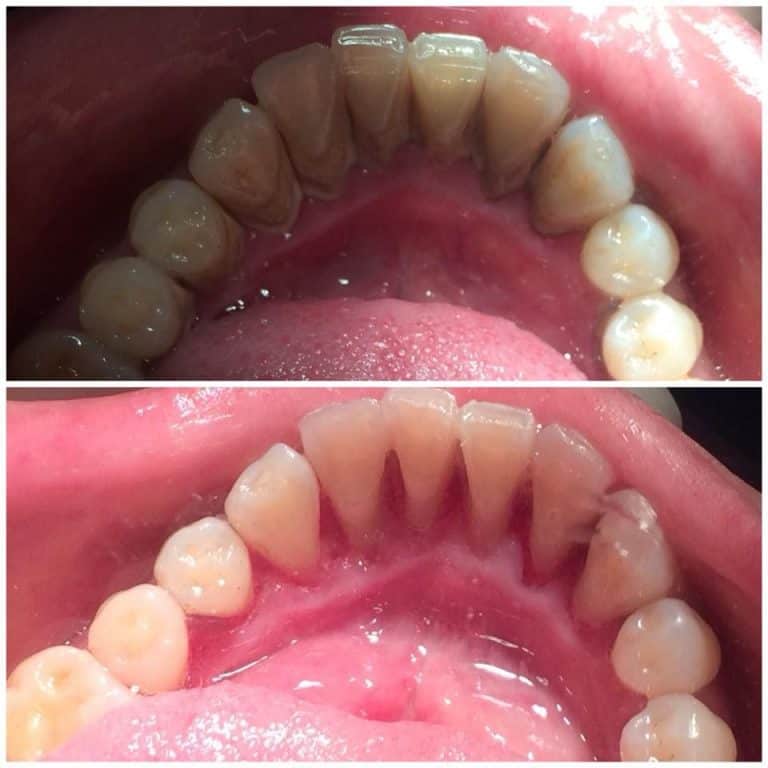 Oral Prophylaxis in Malolos Bulacan - Dr. Keith's Dental Clinic