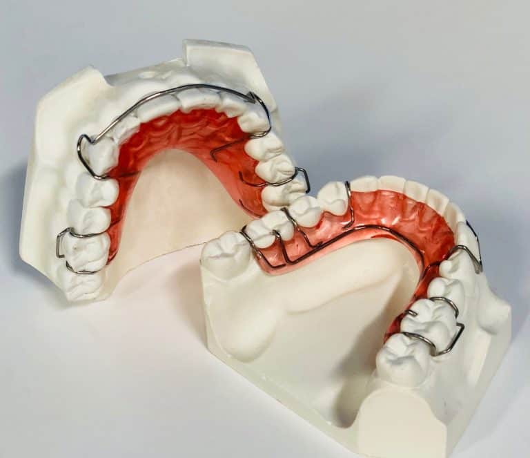 Removable Retainers in Malolos Bulacan | Dr. Keith's Dental Clinic